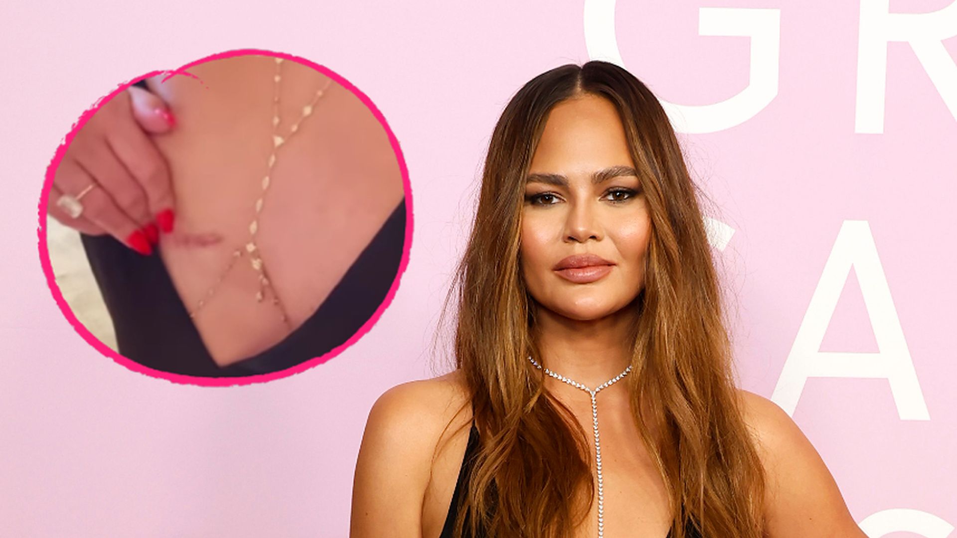 Tiefer Einblick: Chrissy Teigen zeigt ihre OP-Narben