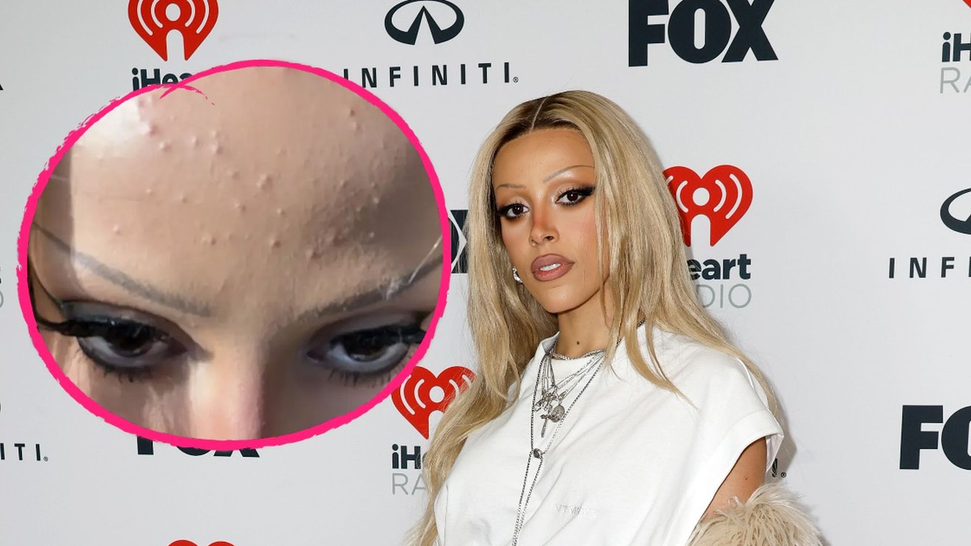 Nach Red Carpet: Doja Cat schämt sich nicht für unreine Haut