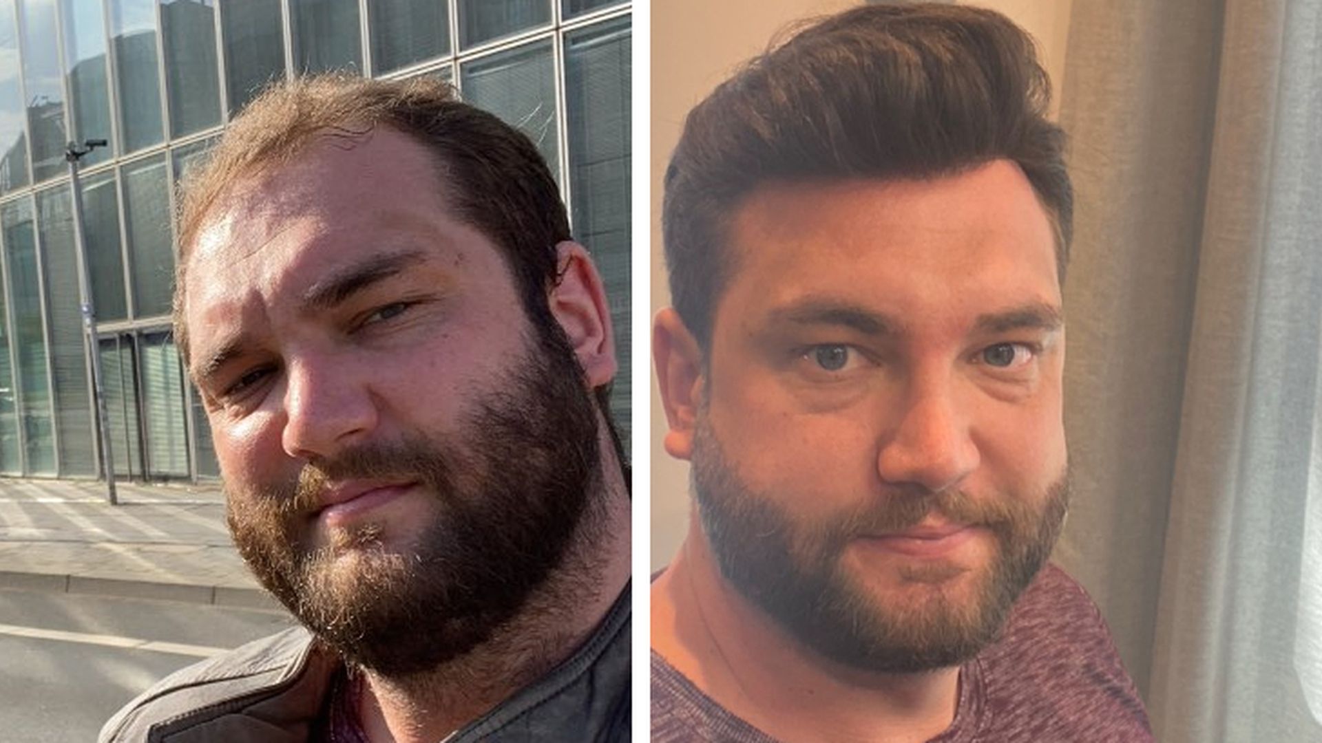 "Hochzeit auf den ersten Blick"-Philipp trägt jetzt Toupet