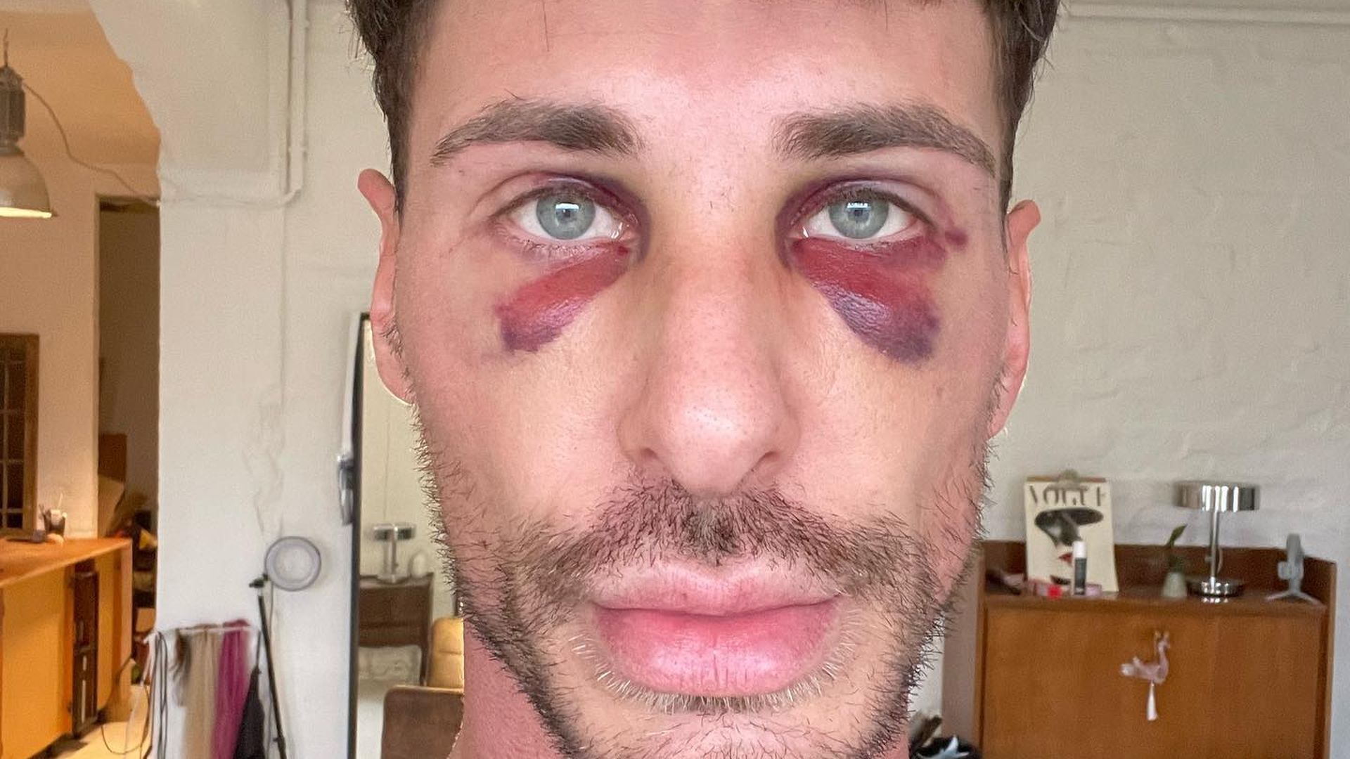 Im eigenen Haus: "Charming Boys"-Pitzi wurde attackiert!