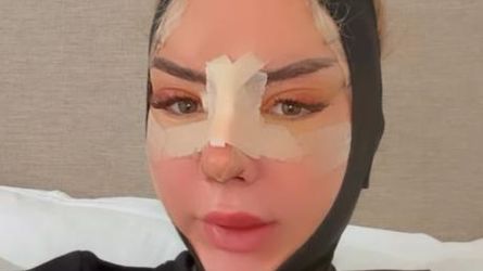 Völlig anders: Emma Fernlund zeigt nach OP ihr neues Gesicht